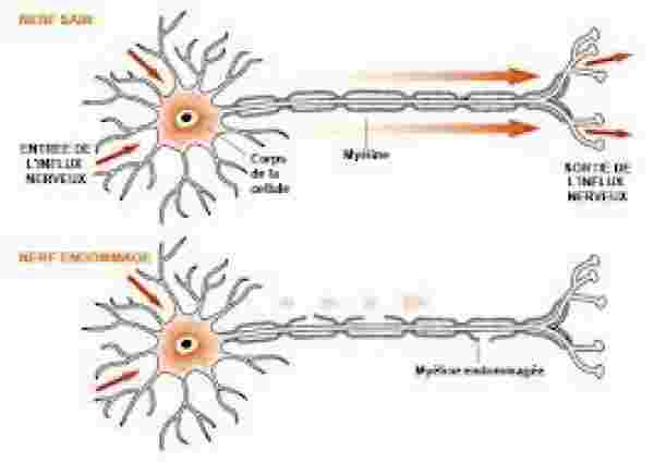 La définition des neuropathies douloureuses